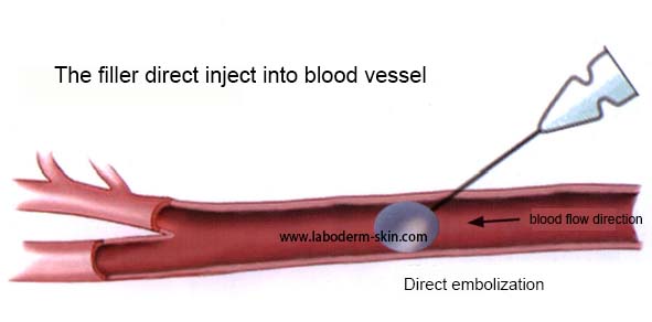 The Risk of DIY filler and treatment for complication