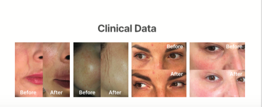 HP Vitaran skin booster PDRN | Salmon DNA | Polydeoxyribonucleotide