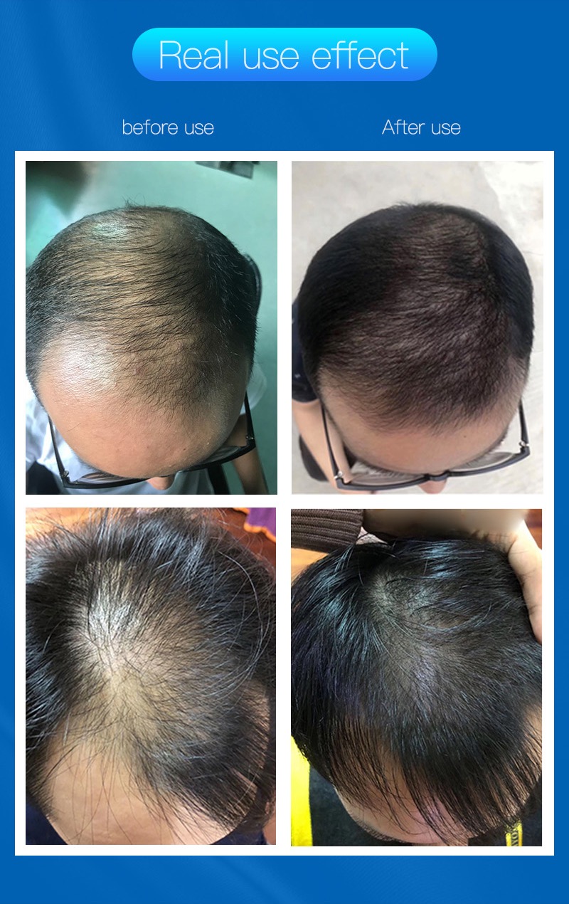 LLLT Laser Therapy Hair Growth System Regrowth Cap | FDA CE Cleared