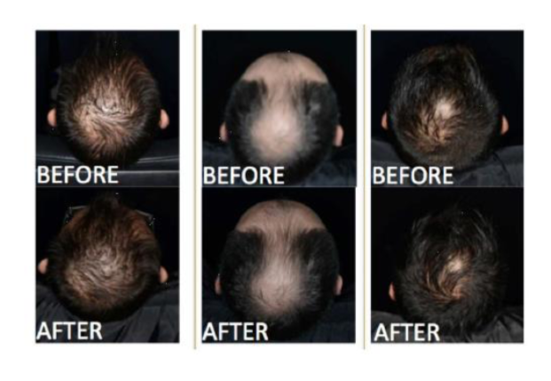 A-SCAL Stem Cell Exo hair growth solution 3ml*5 - Laboderm Skin Care ...